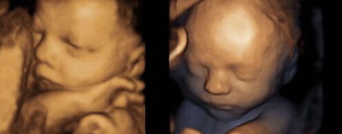 4D Ultrasound Scanning - Alpha IVF Fertility Center Malaysia