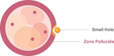 Laser Assisted Hatching - Alpha IVF Fertility Center Malaysia